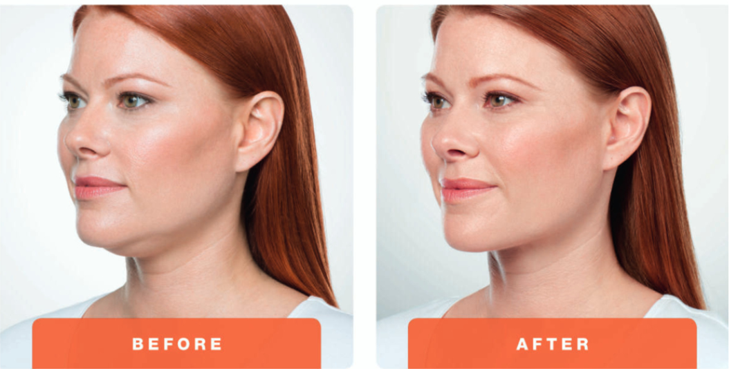 St. Clair Cosmetic ClinicYouthful Jawline Contouring with Belkyra - St ...